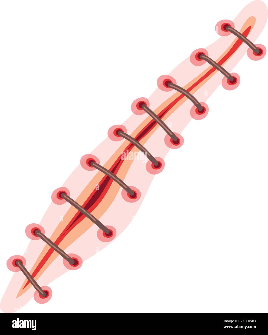 Stitched wound. Lacerated skin cut. Bloody scar isolated on white background Stock Vector Image ...