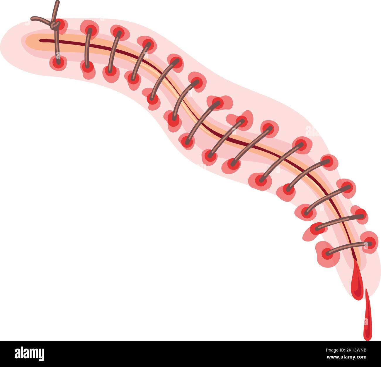 Skin stitches. Wounded body mark. Surgery scar isolated on white background Stock Vector Image ...