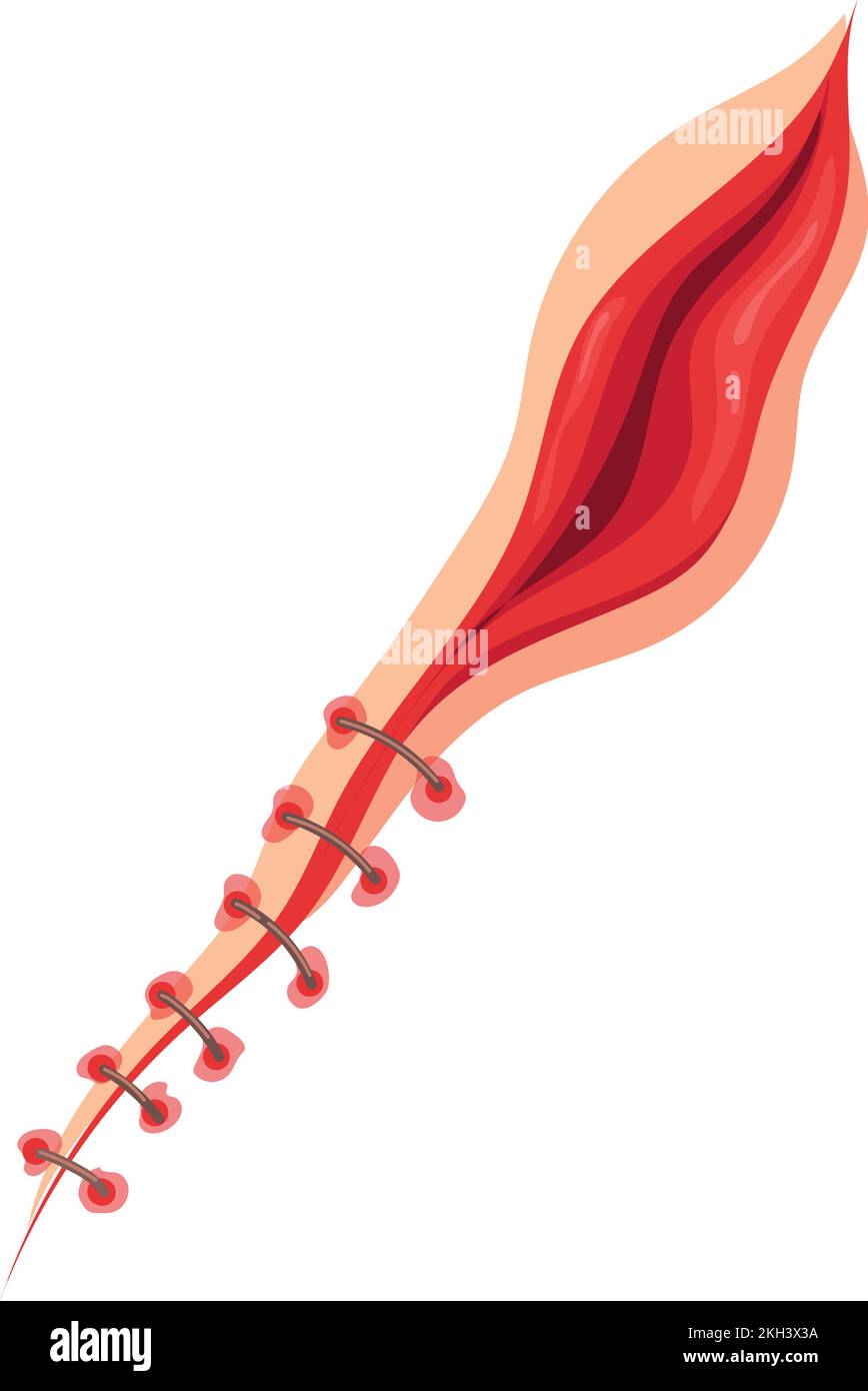Injured skin. Bloody cut with surgical stitches. Body scar isolated on white background Stock ...