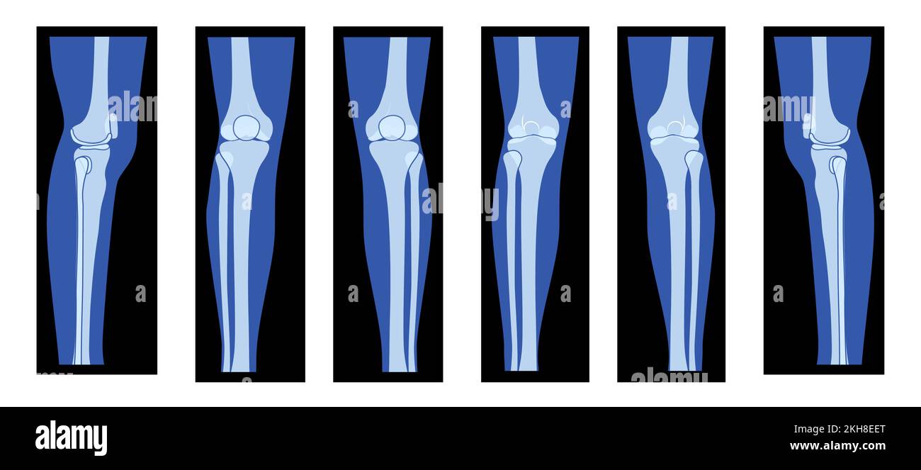 Set of X-Ray Knee femur leg Skeleton Human body - Patella, epicondyle ...