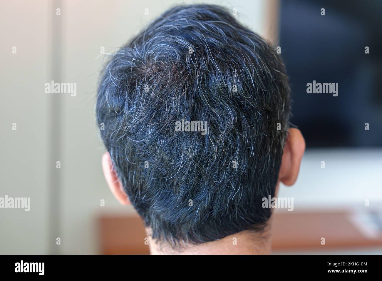 asian man having grey and white hair growing up. Hair problem concept ...
