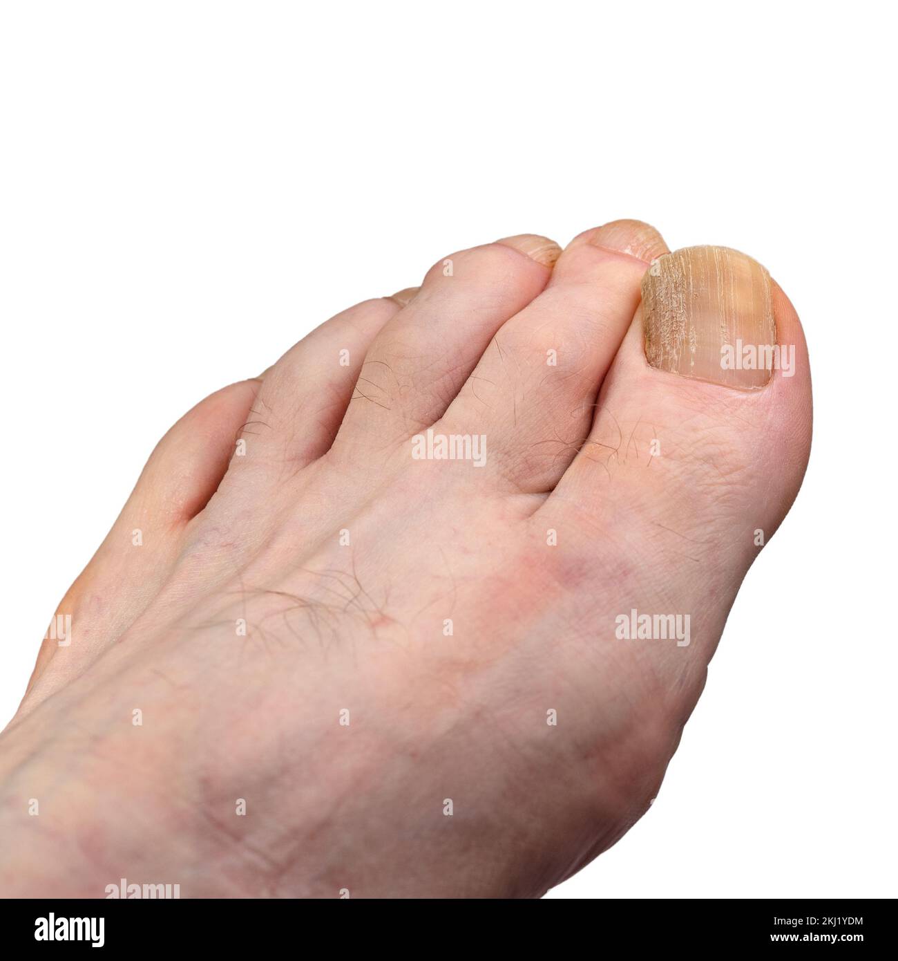 Fungal nail hi-res stock photography and images - Alamy