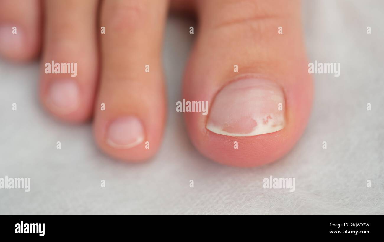 Female foot with damaged nail, fungus disease Stock Photo - Alamy