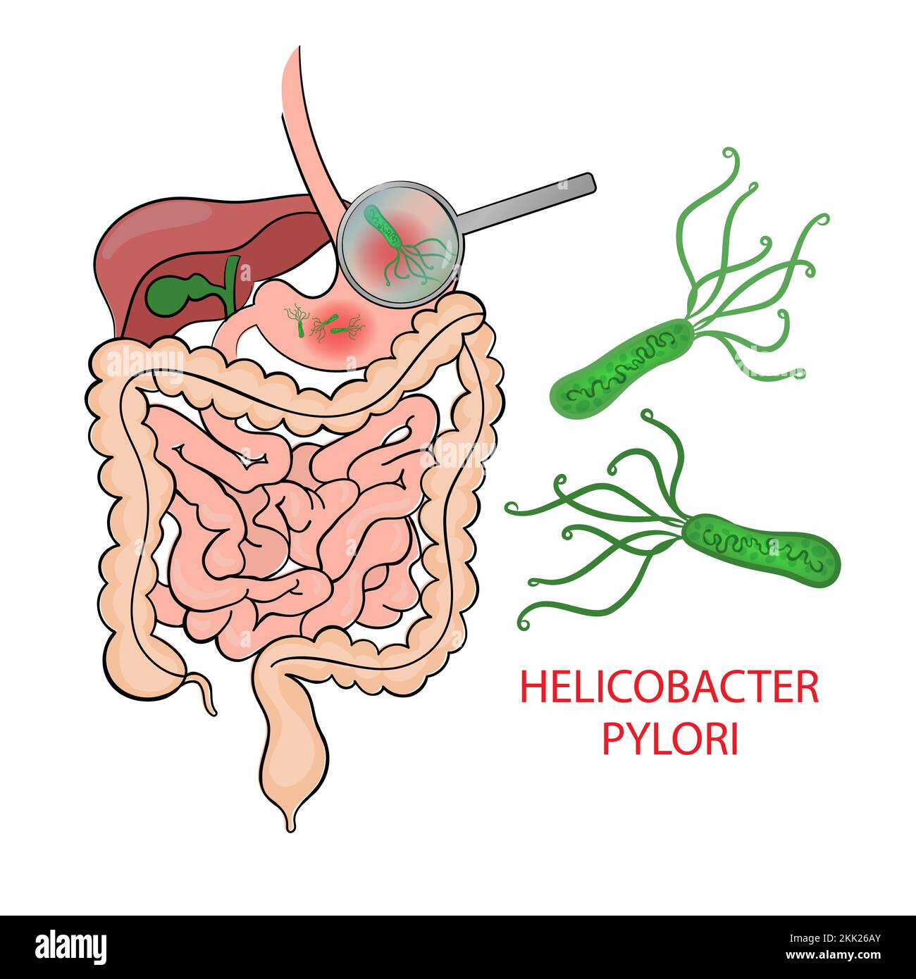 HELICOBACTER PYLORI Medicine Education Diagram Vector Scheme Human Illness Vector Illustration ...