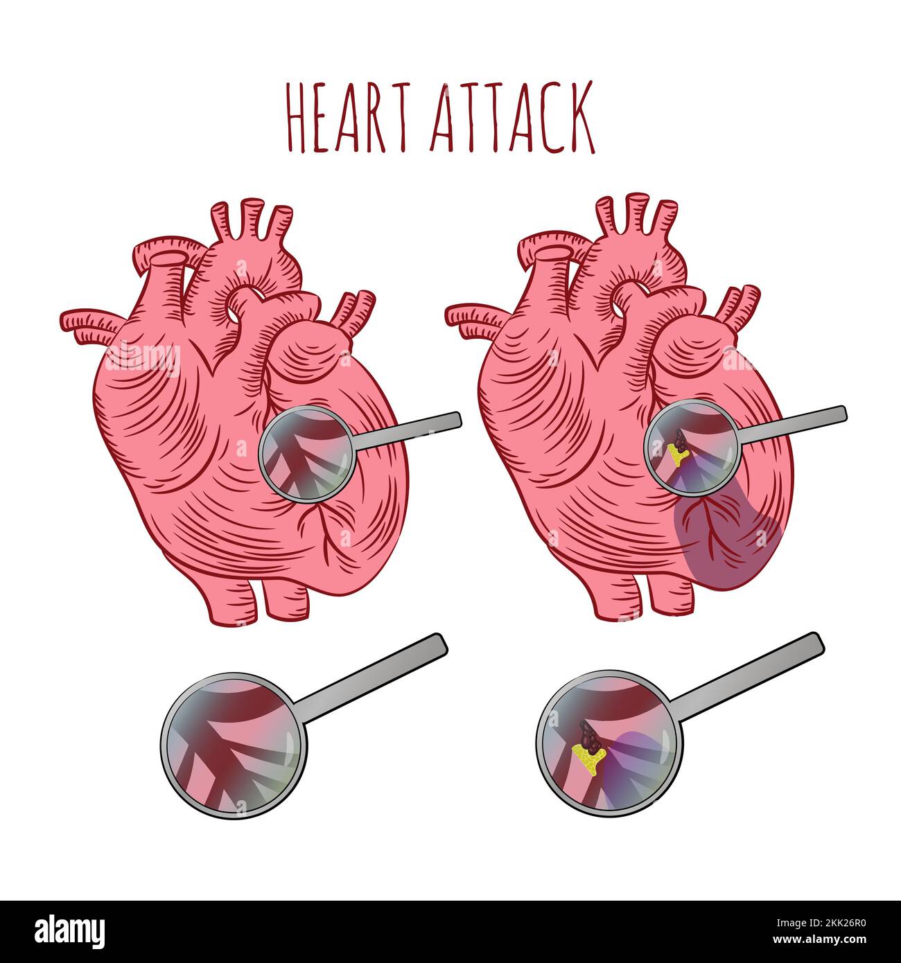 HEART ATTACK Atherosclerosis Chronic Disease Medicine Education Diagram ...