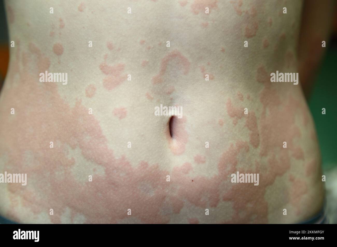 Allergic reaction skin rash hi-res stock photography and images - Alamy