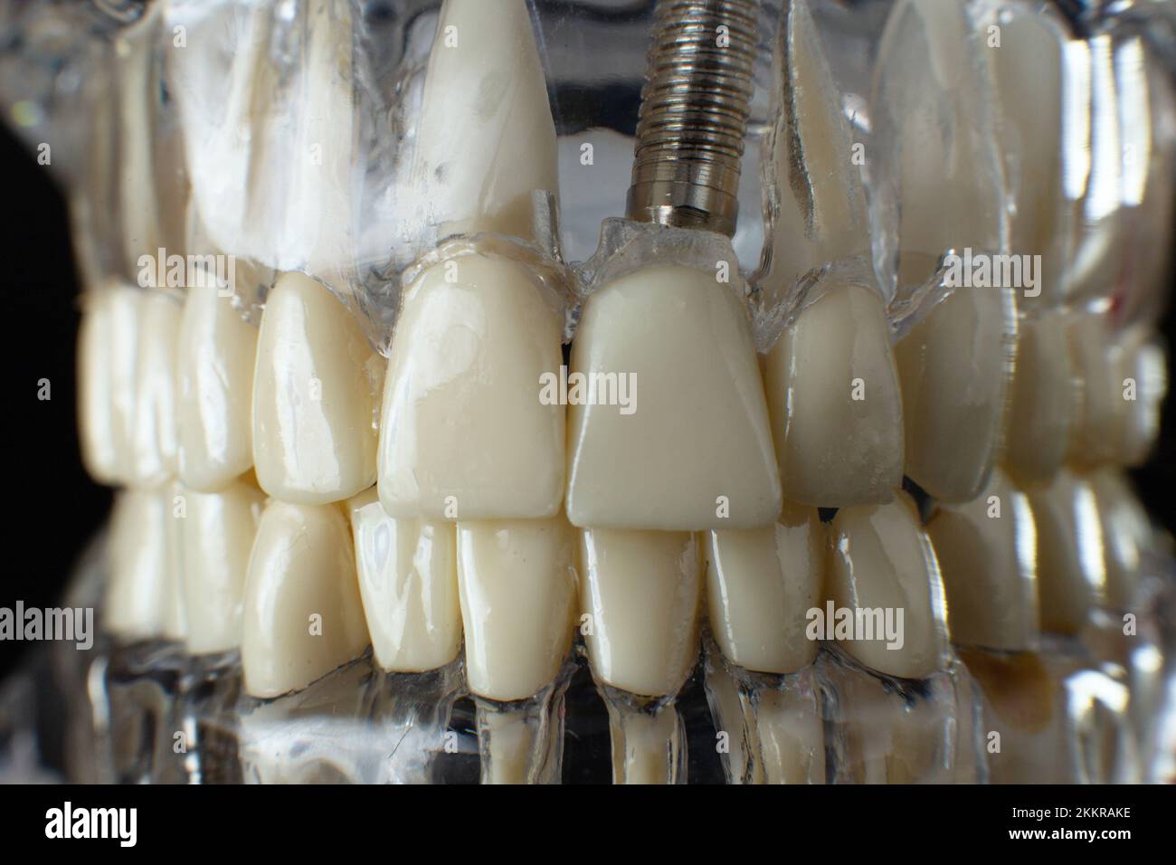 Dental jaw model over black background. Dentist dental prosthetic teeth ...