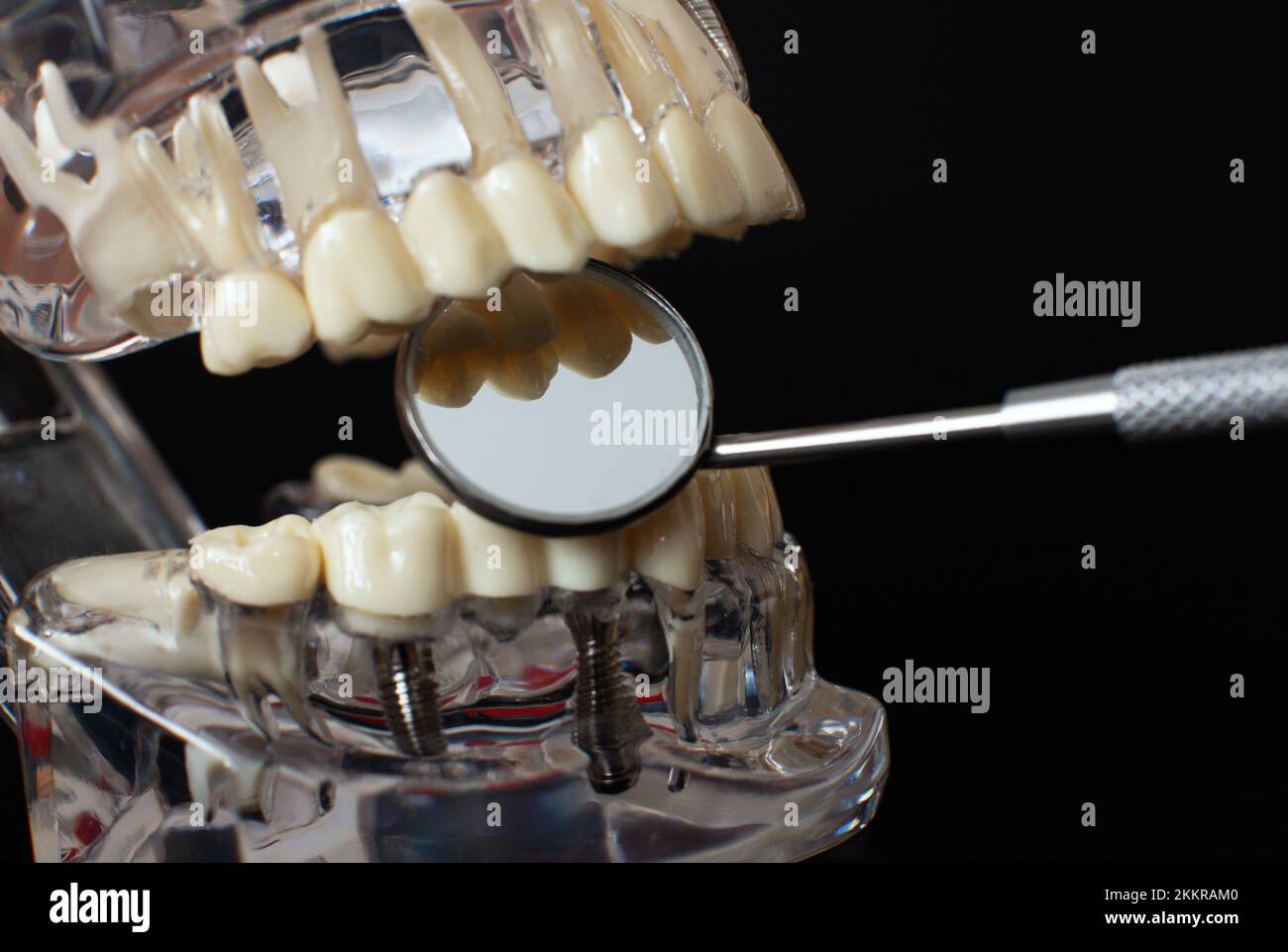 Dental jaw model over black background. Dentist dental prosthetic teeth ...