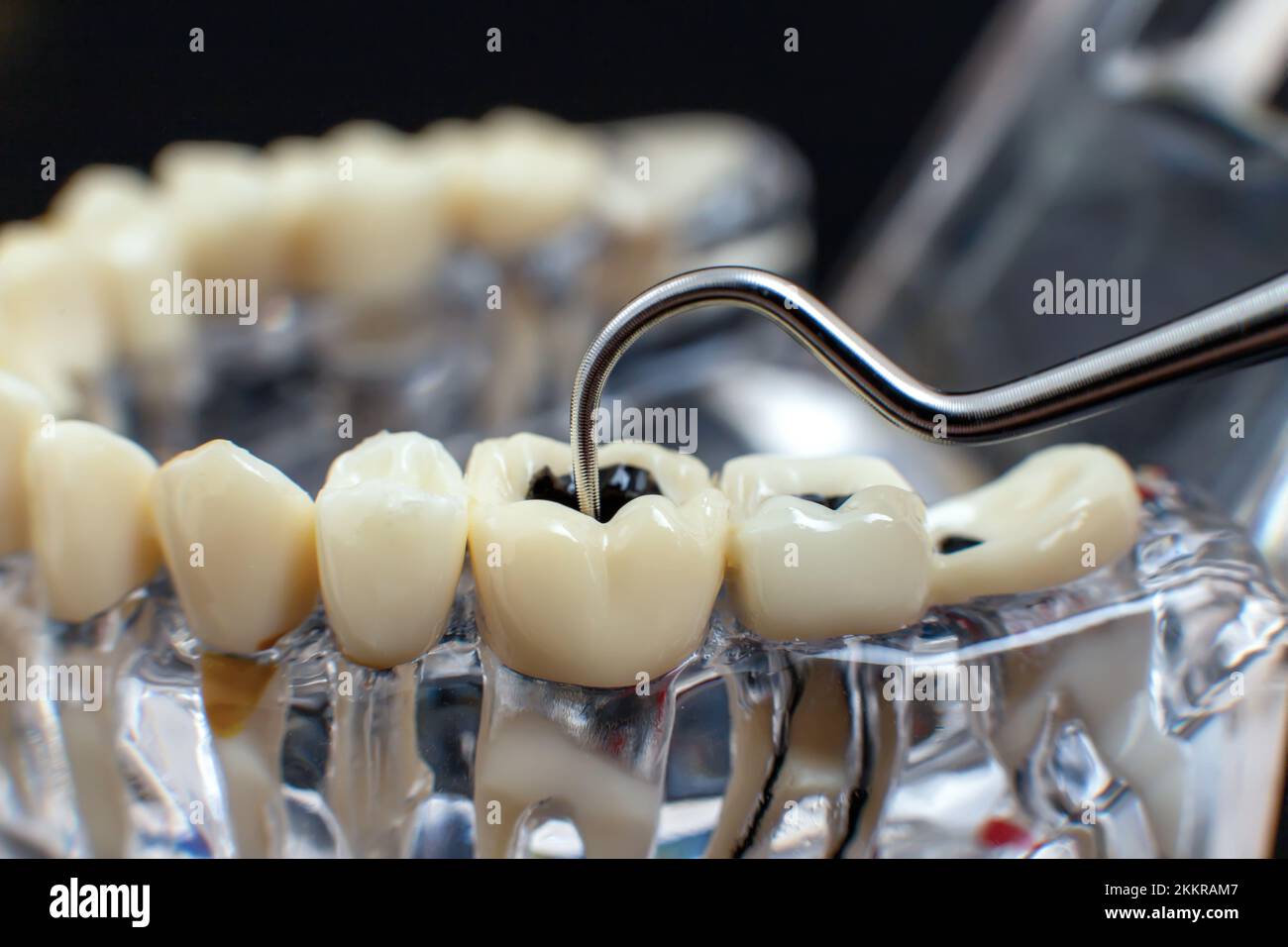 Dental jaw model over black background. Transparent invisible dental ...