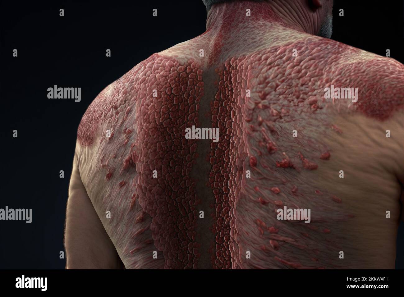 Shingles rash back hi-res stock photography and images - Alamy