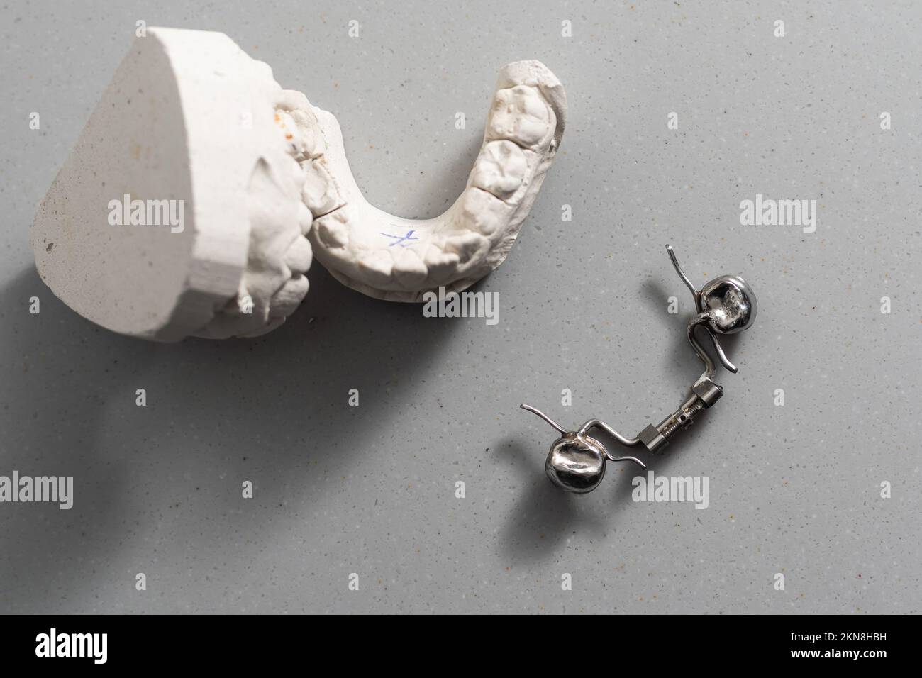 Dental casting gypsum model of human jaws. Crooked teeth and distal ...