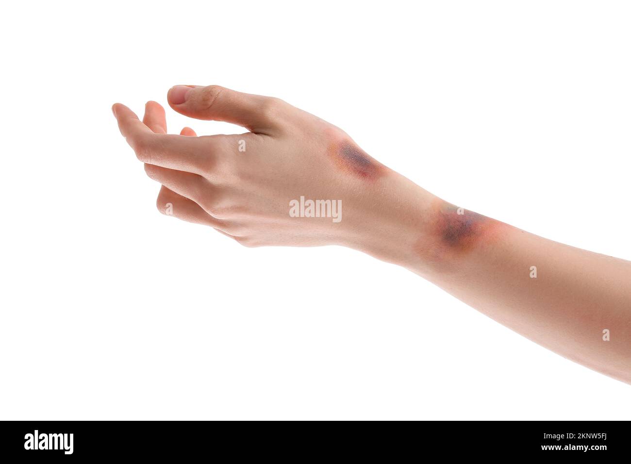 Bruised skin Cut Out Stock Images & Pictures - Alamy