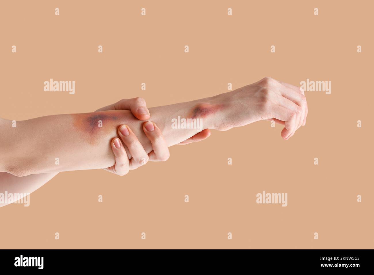Bruised female hands on beige background Stock Photo - Alamy