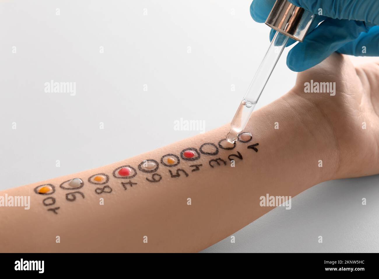 Doctor making allergy skin test on patient's hand in clinic, closeup ...