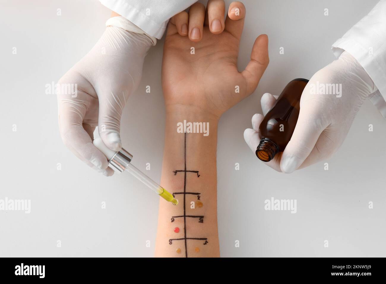 Doctor with dropper and patient's marked hand for allergy skin tests on ...