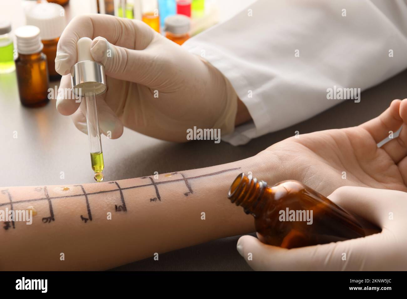 Doctor with dropper making allergy skin test on patient's hand in ...