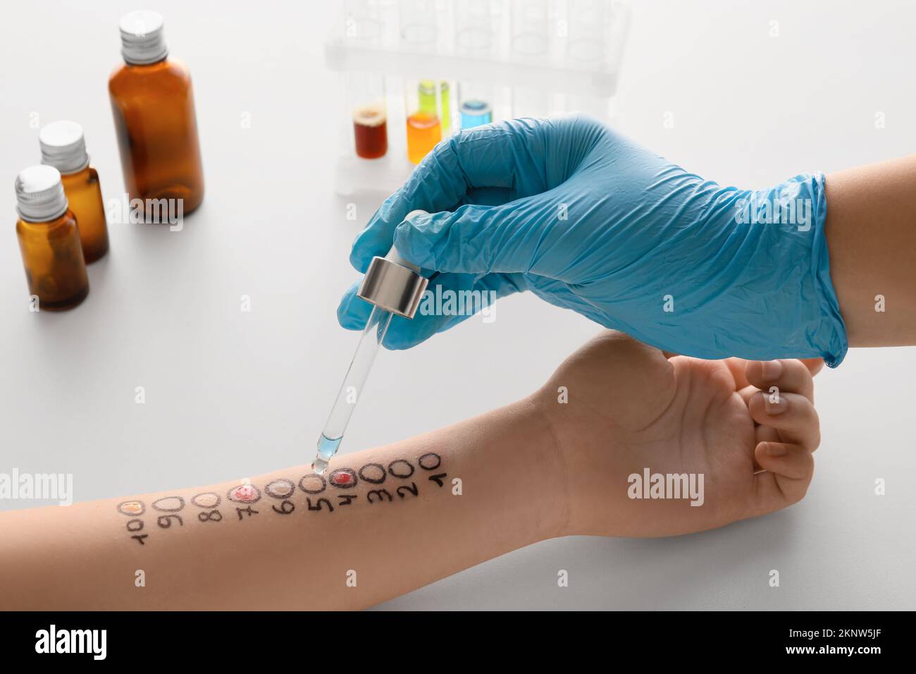 Doctor making allergy skin test on patient's hand in clinic, closeup ...