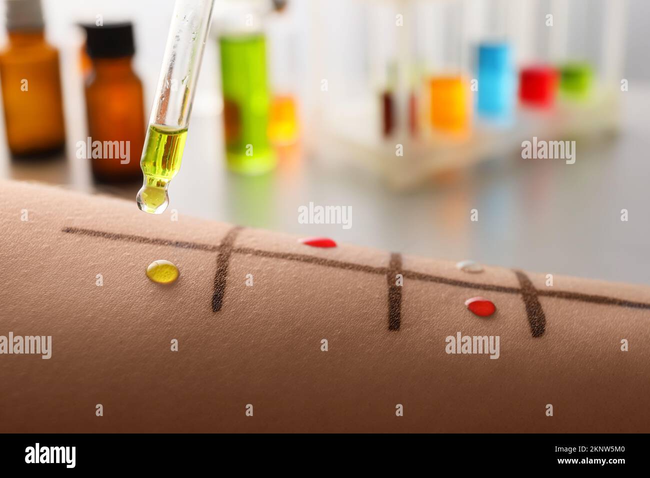 Woman undergoing procedure of allergen skin tests in clinic, closeup ...