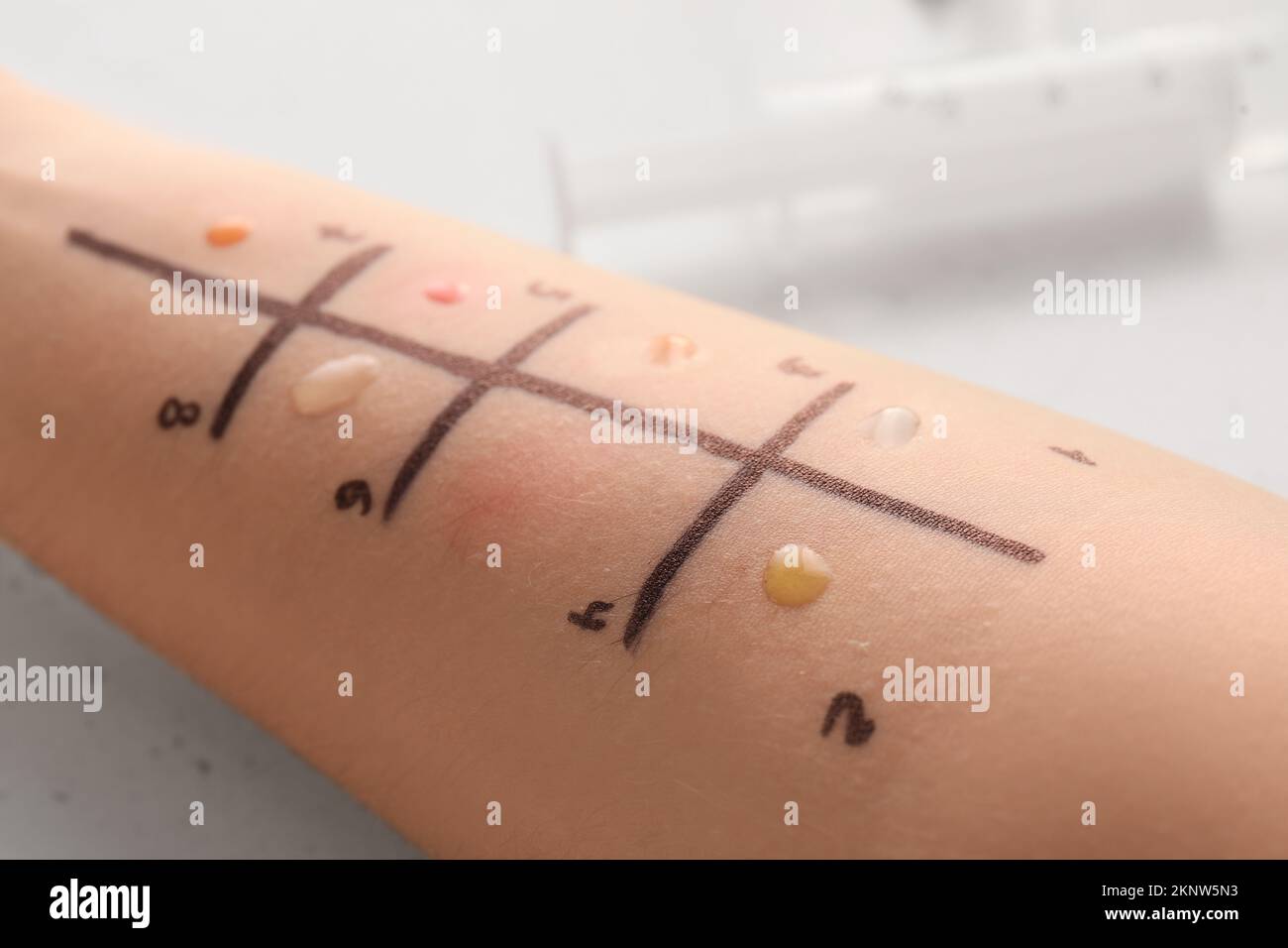 Marked female hand for allergy skin tests on table in clinic, closeup ...