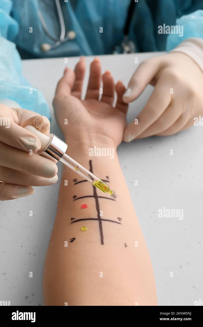 Doctor with dropper making allergy skin test on patient's hand in ...