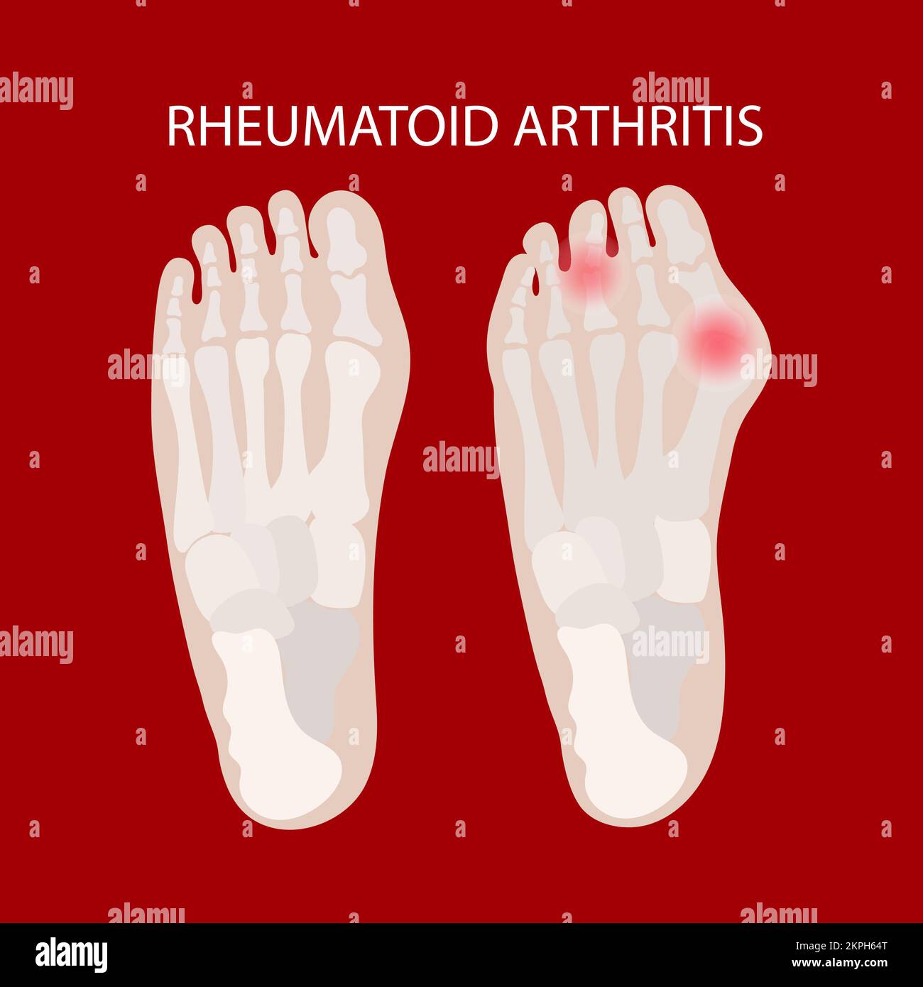 RHEUMATOID LEG Lesions Arthritis Educational Scheme For Medical Schools ...