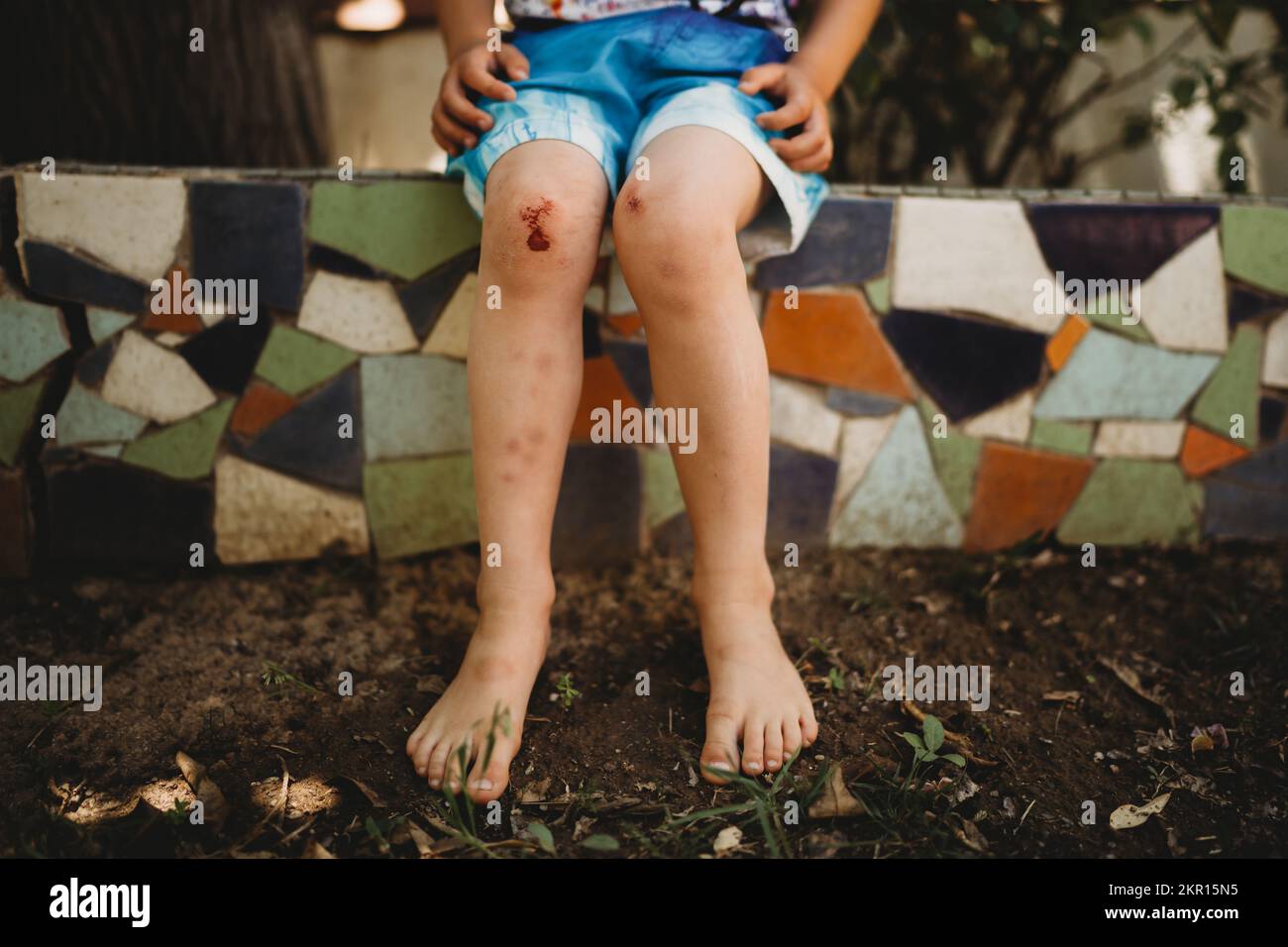Child scraped bleeding knees from playing in summer legs with bruises ...