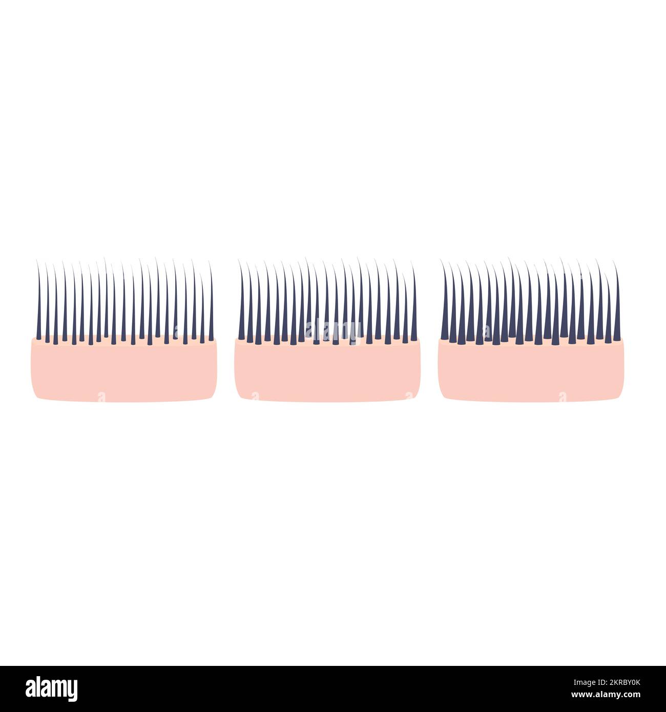 Hair thickness set on scalp skin cross-section icon Stock Vector Image ...