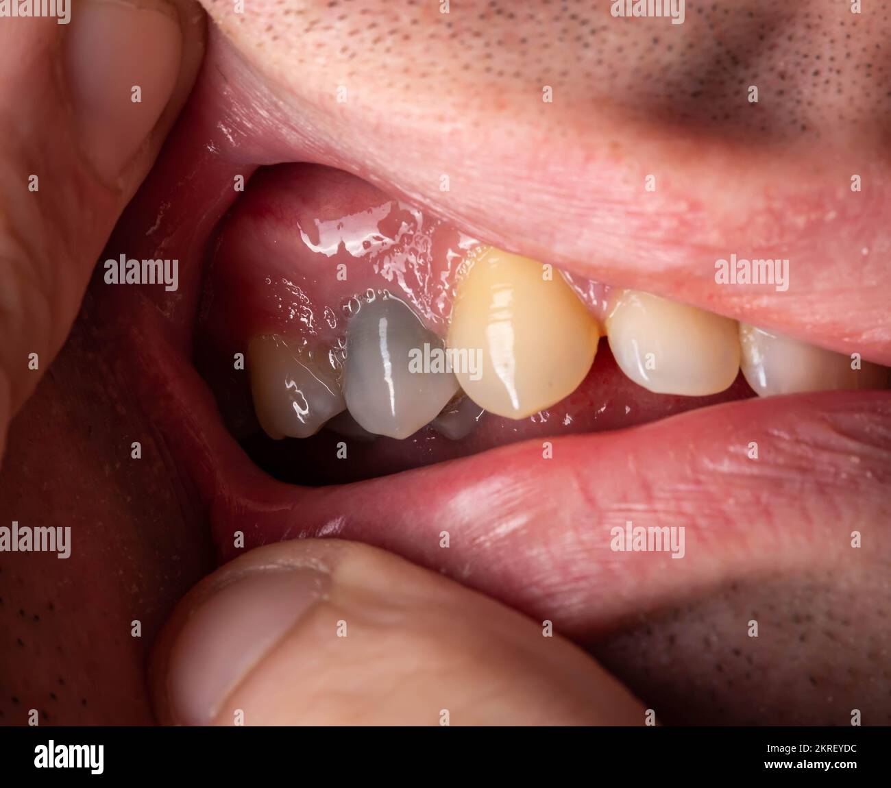 A black tooth in a man's mouth after removal of a nerve and filling of ...