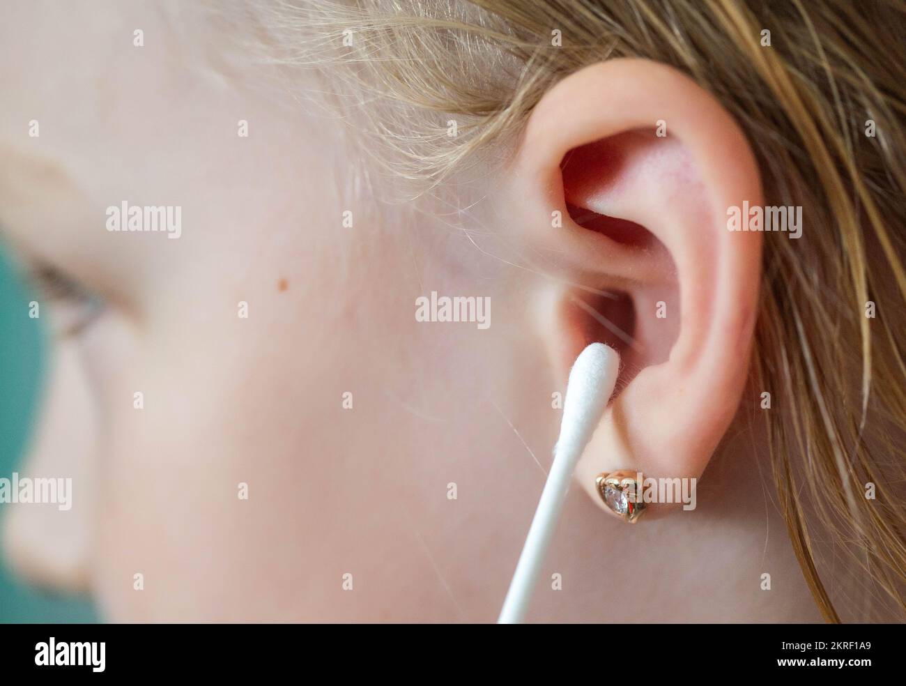 Cleaning the ears of a 5-year-old child from sulfur with cotton swabs ...