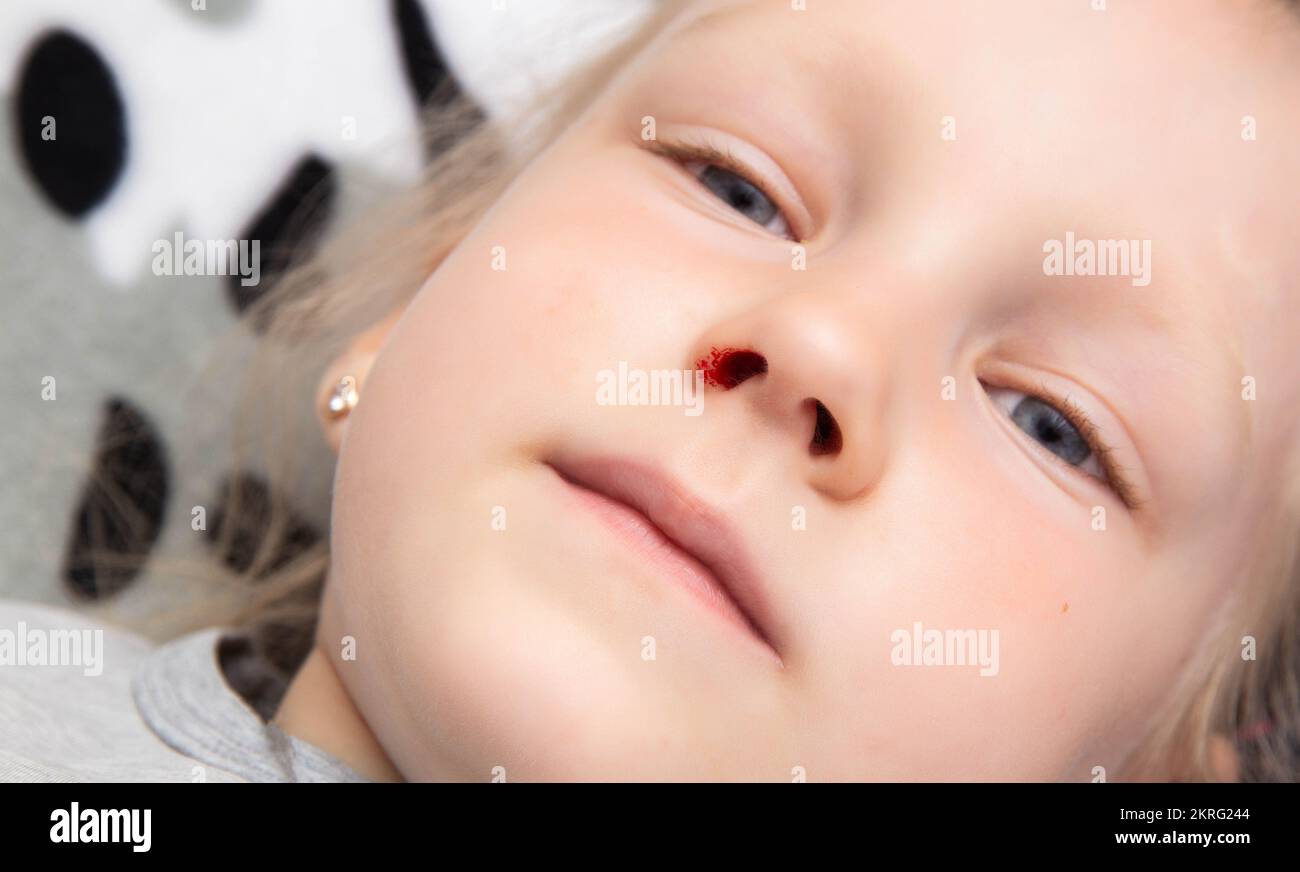 The face of a little caucasian girl with a nosebleed. Nosebleeds in ...