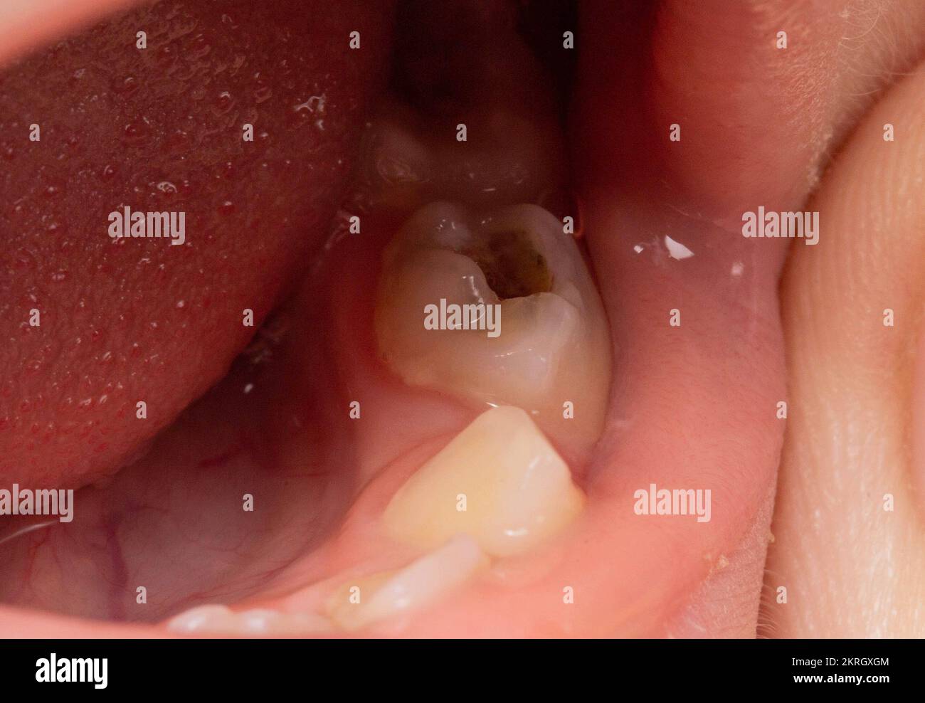 Deep caries in children on milk teeth. Treatment of caries, toothache ...