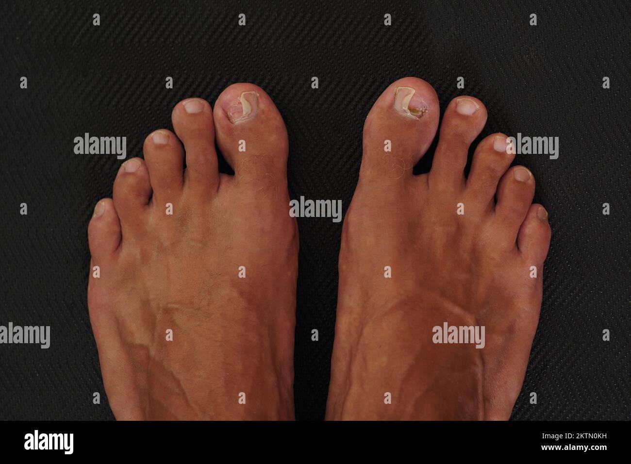 Toenail peel away with parts splitting or broken off. Cracked nail ...