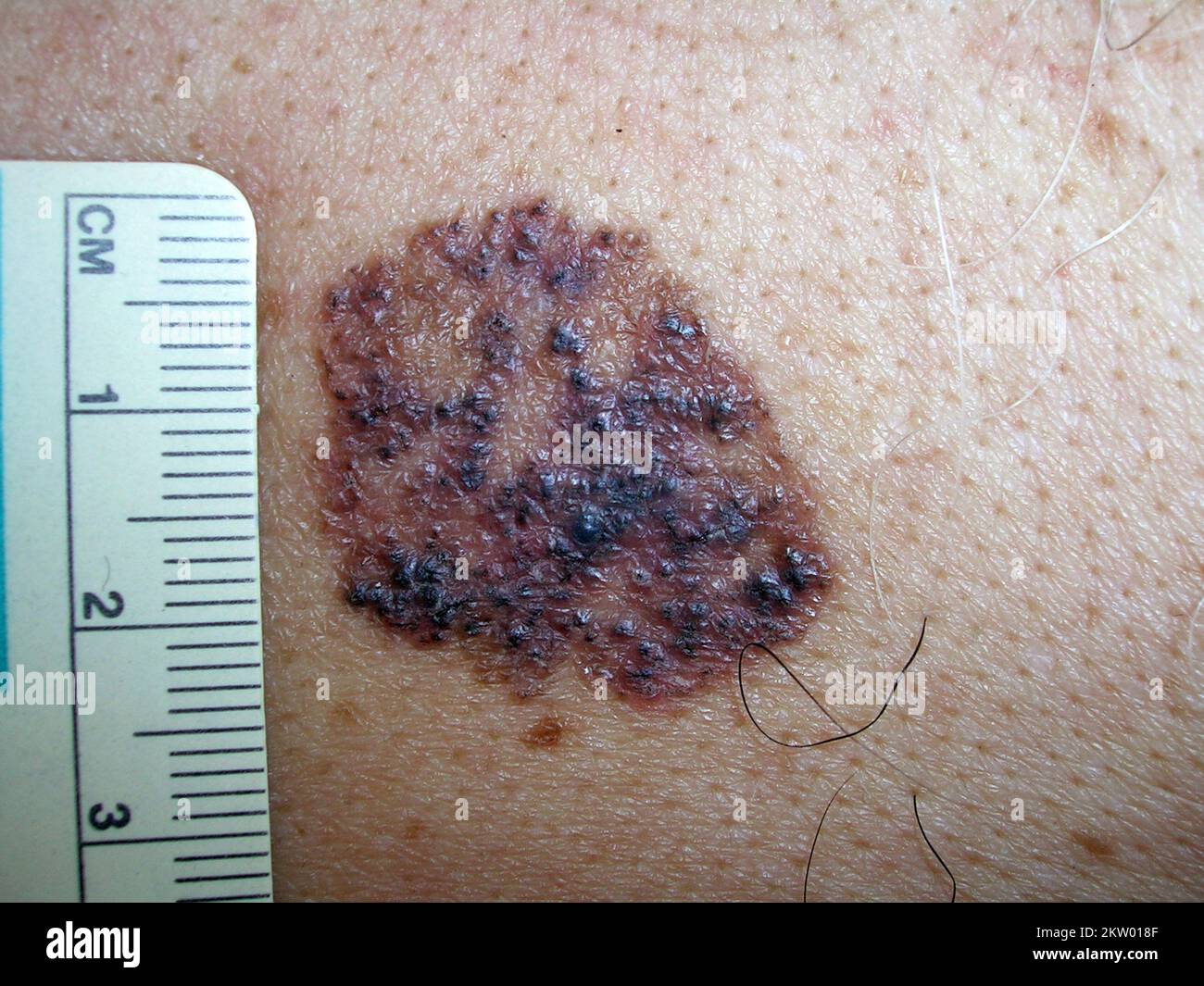 Basal cell carcinoma Stock Photo - Alamy
