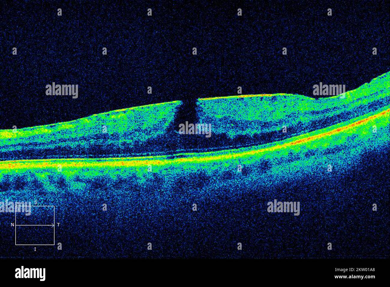 Macular pucker with lamellar hole, OCT scan Stock Photo - Alamy