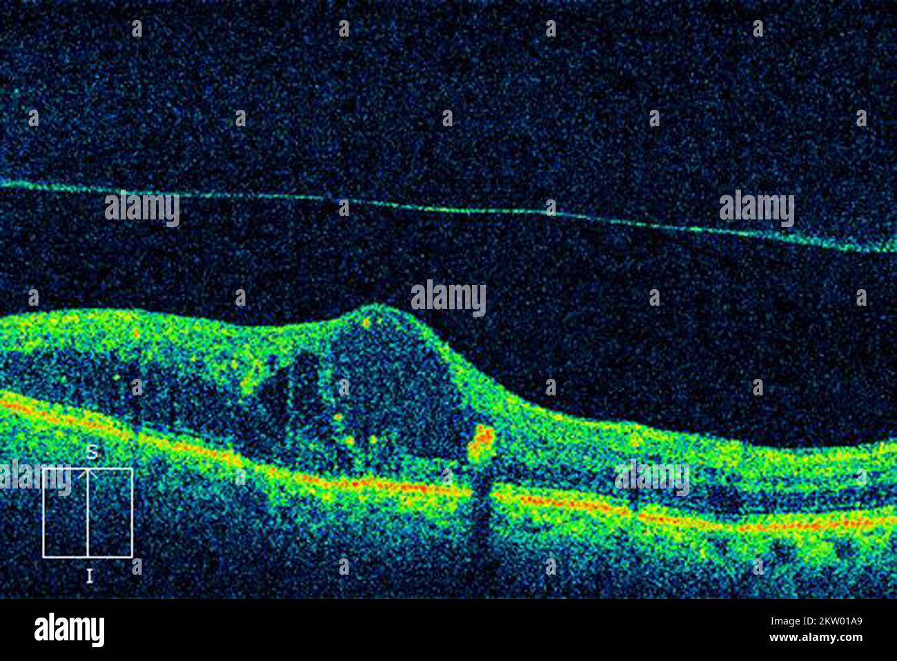 Diabetic macular oedema, OCT scan Stock Photo - Alamy