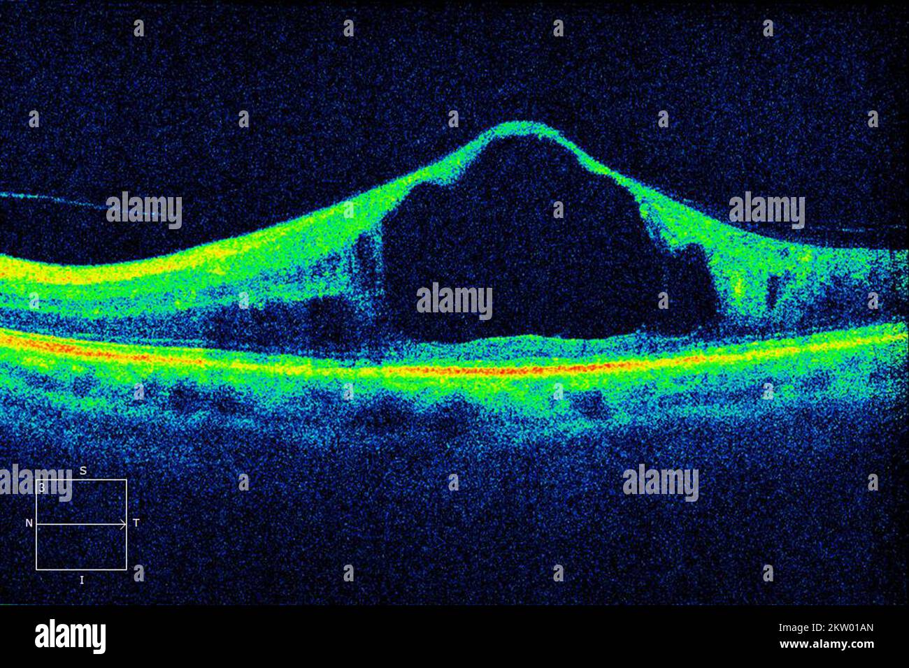 Diabetic macular oedema, OCT scan Stock Photo - Alamy Diabetic macular oedema, OCT scan Stock Photo - Alamy