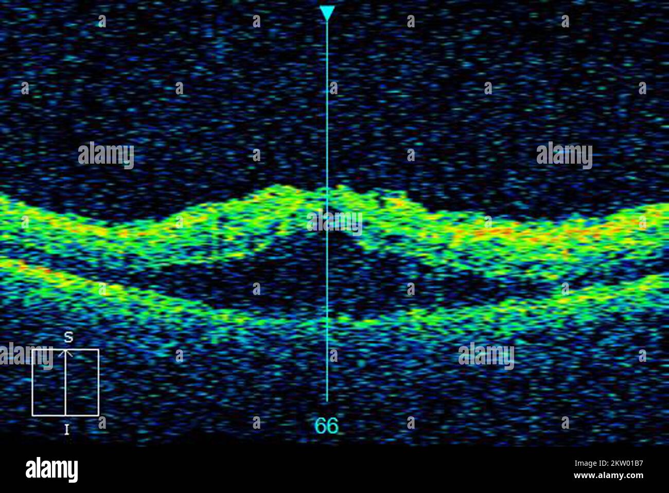 Diabetic macular oedema, OCT scan Stock Photo - Alamy Diabetic macular oedema, OCT scan Stock Photo - Alamy