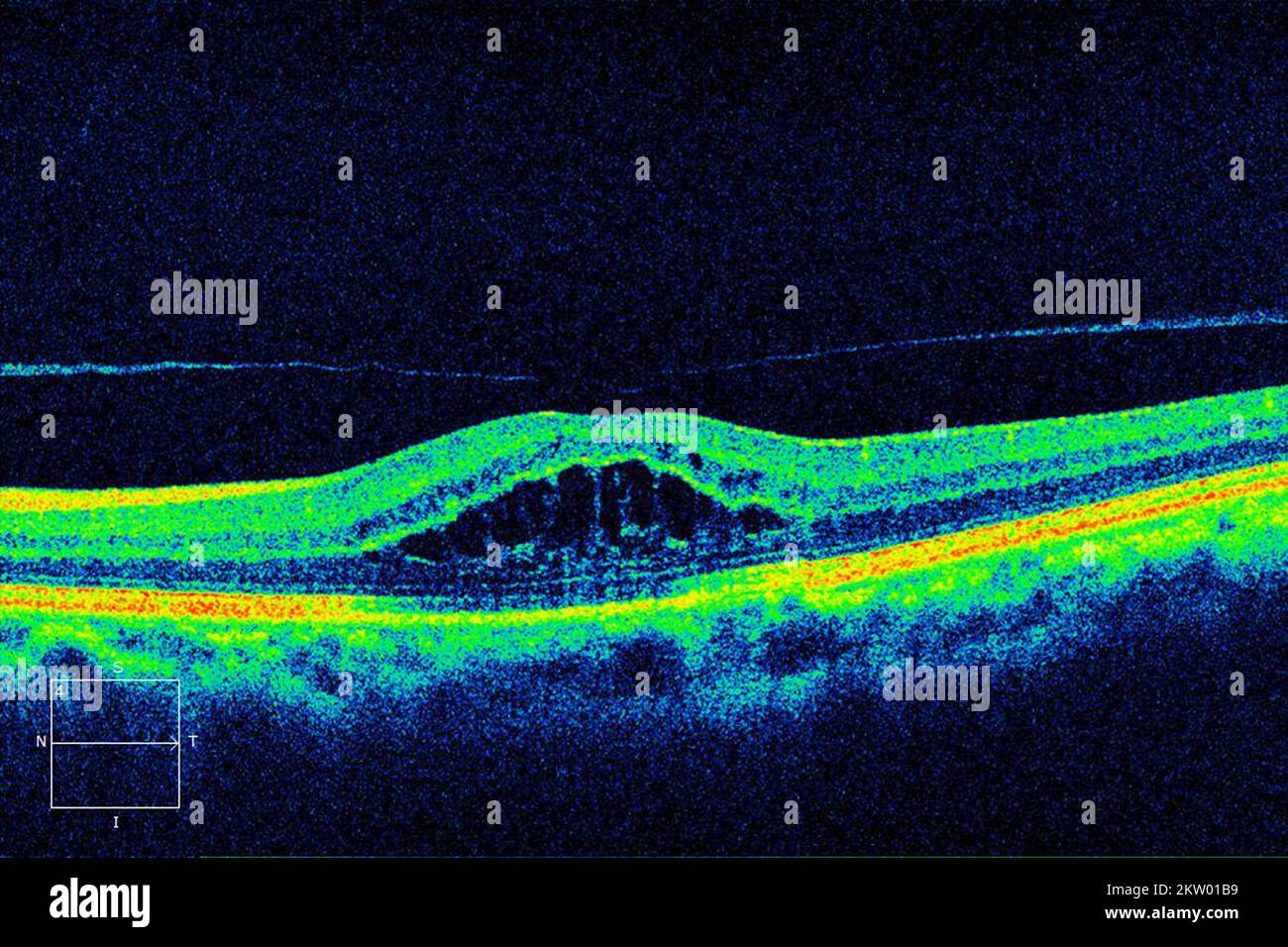 Cystoid macular oedema, OCT scan Stock Photo - Alamy