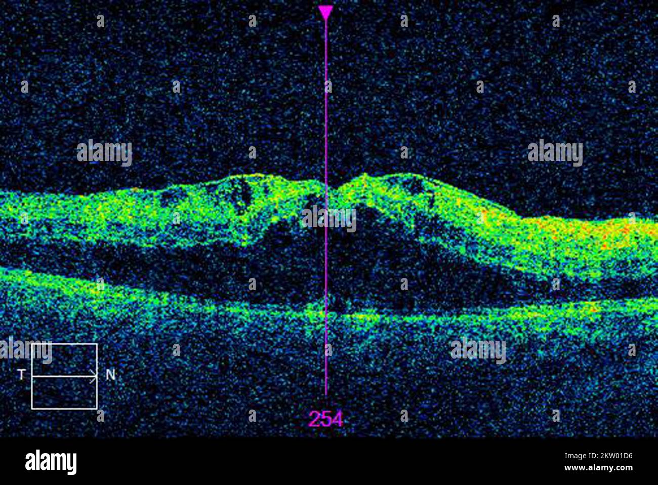 Diabetic macular oedema, OCT scan Stock Photo - Alamy