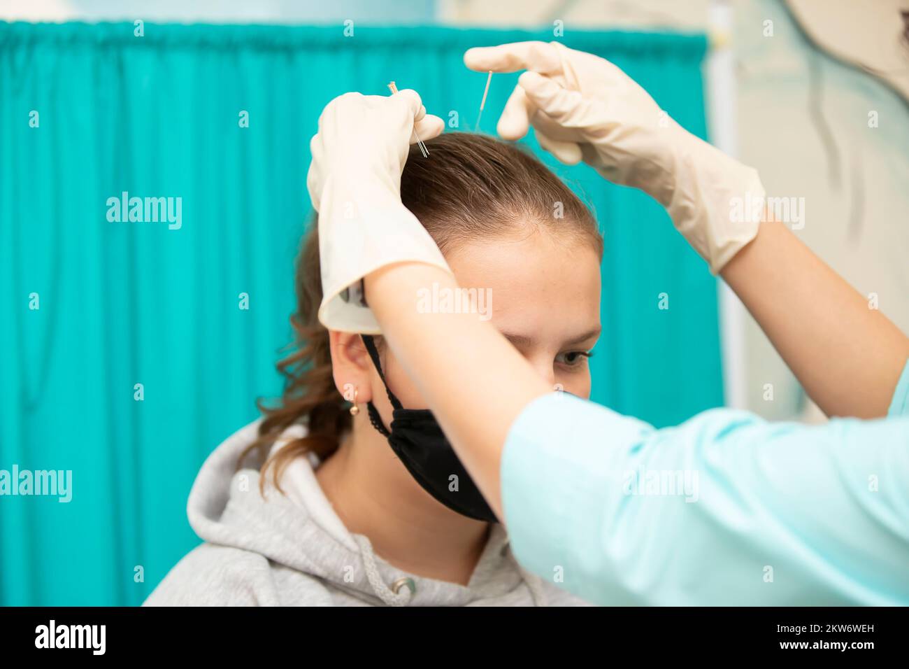The doctor makes acupuncture on the head of a teen patient Stock Photo ...