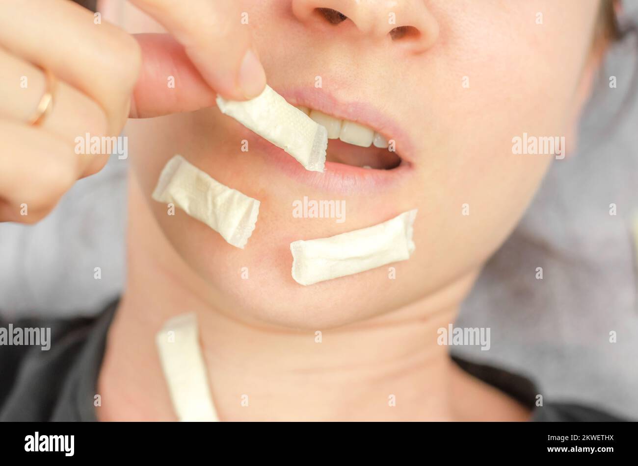 Lip cancer hi-res stock photography and images - Alamy