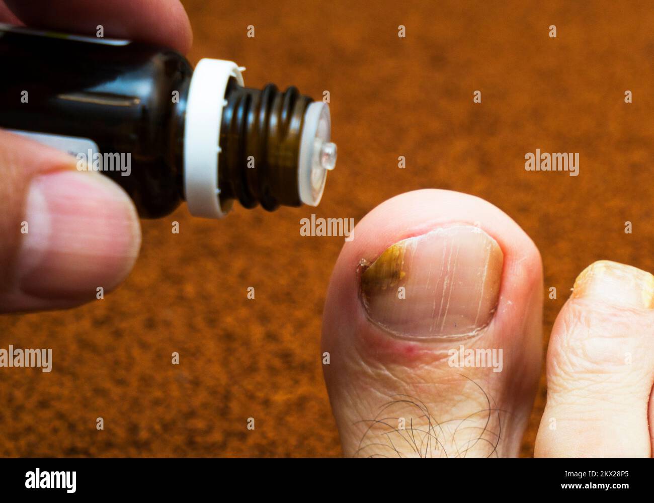 Toe and nail fungus. Dermatologist. The doctor treats the patient's ...