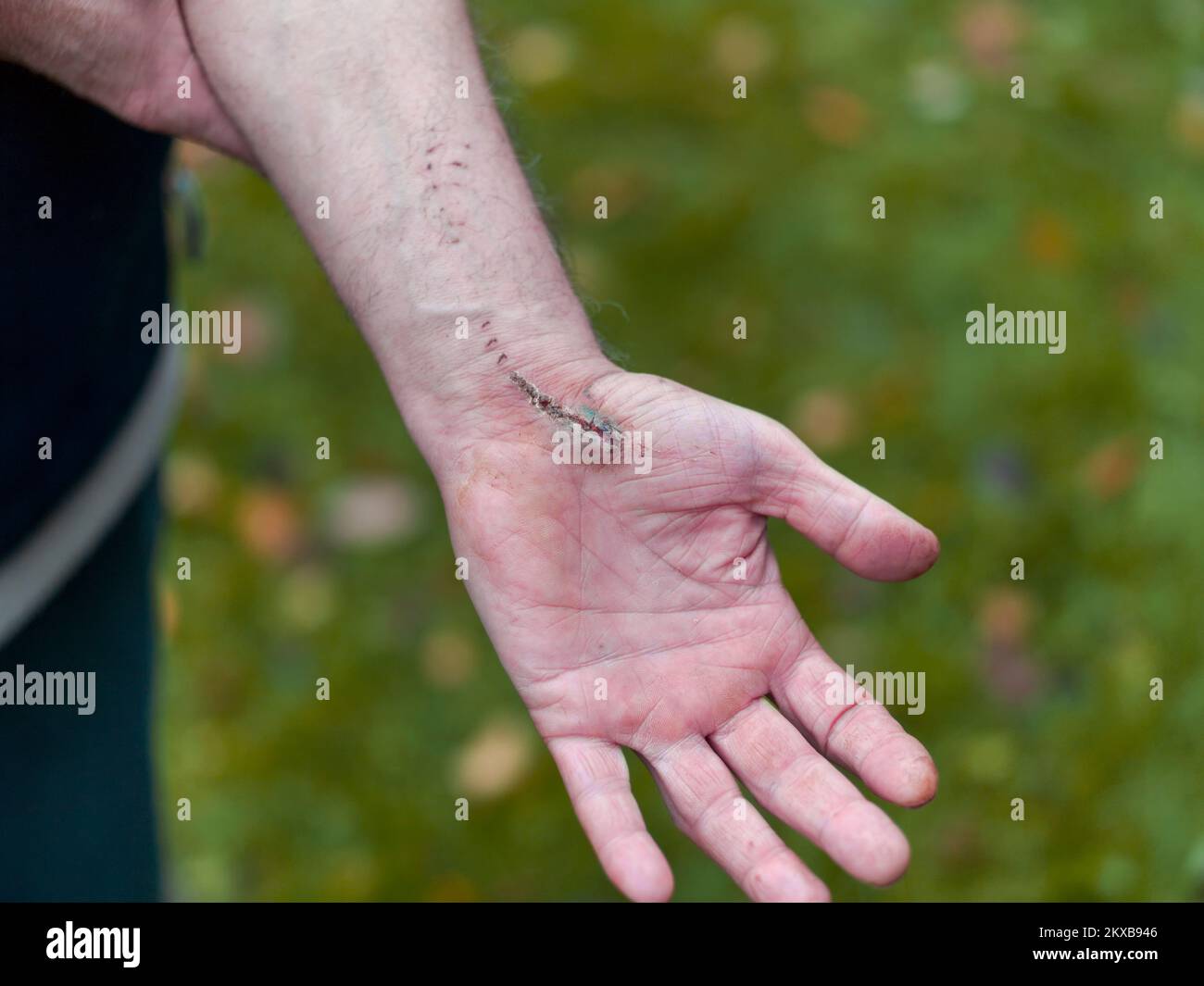 marks of a chainsaw on a male damaged arm, outdoor closeup Stock Photo ...