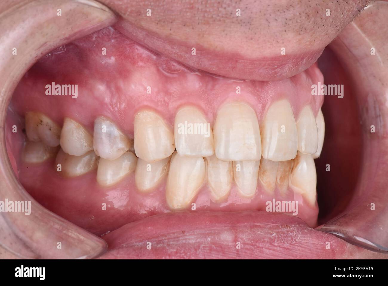 Close up side view teeth picture fixator dental examination before ...