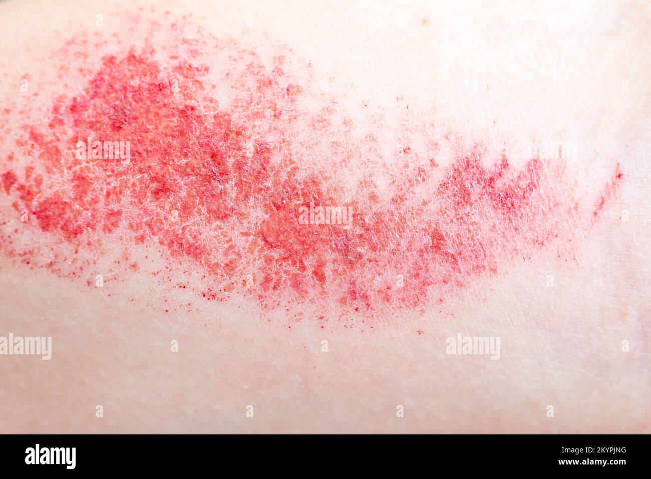 Children's hand burn. Children's hand with a burnt wound on a white ...