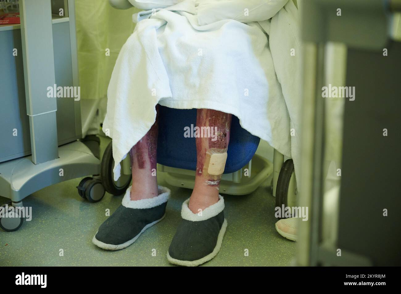 Berlin, Germany. 30th Nov, 2022. The legs of a patient who suffered ...