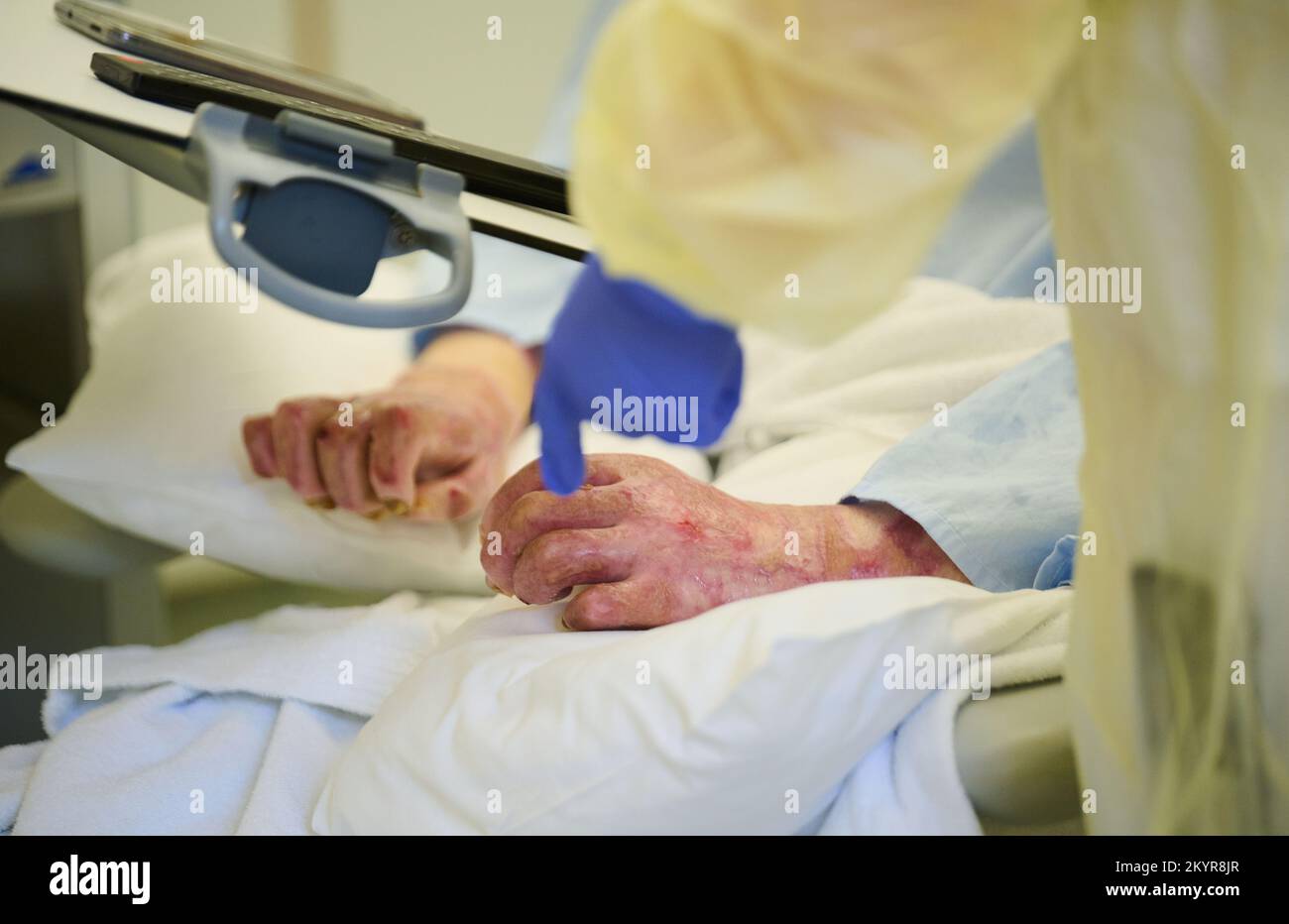 Hand burns patients hi-res stock photography and images - Alamy