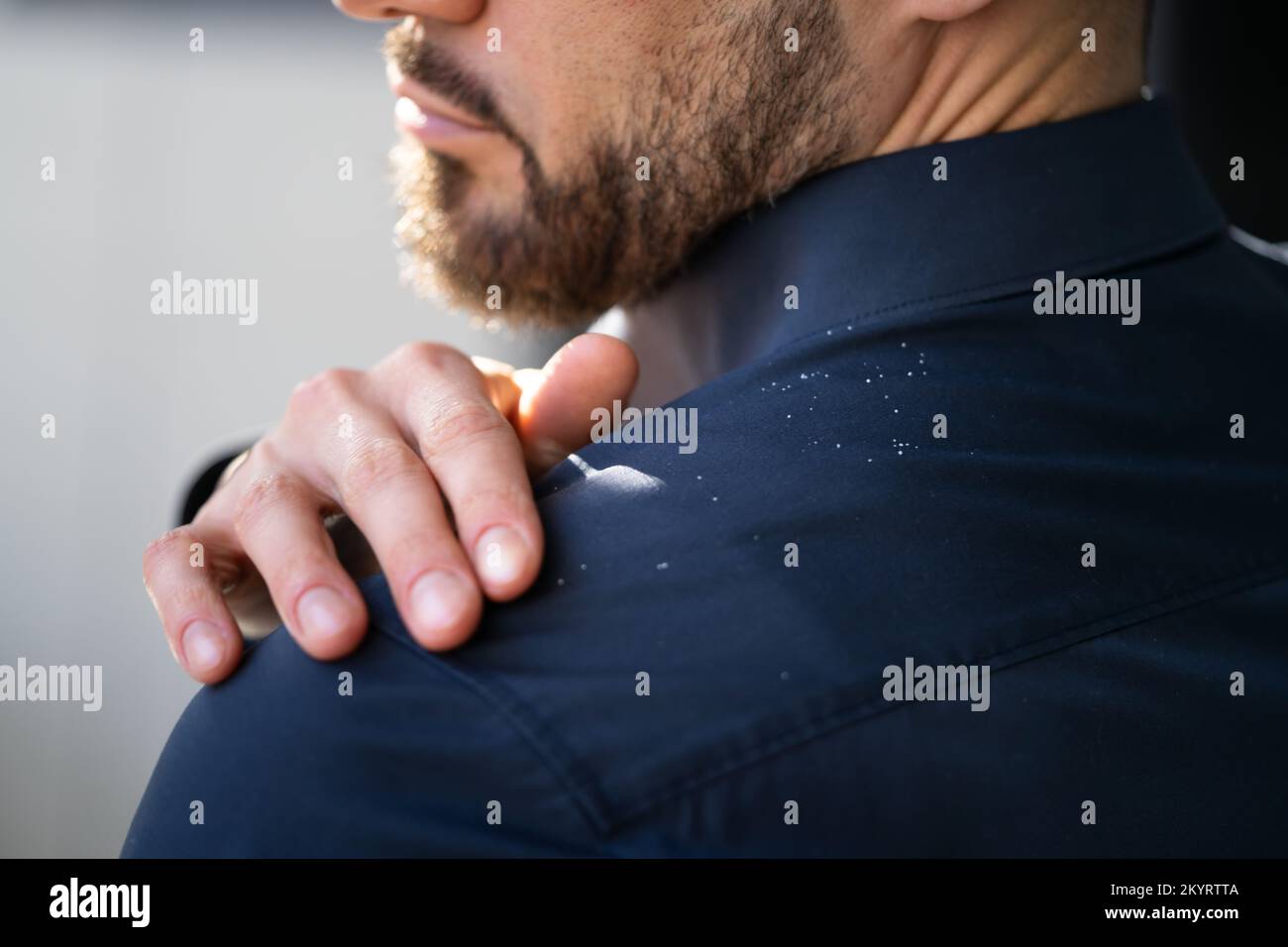 Dandruff On Shoulders