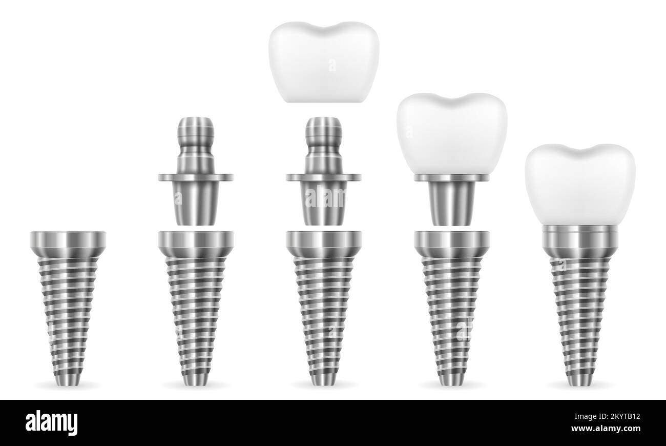 metal human tooth implant vector illustration isolated on white ...