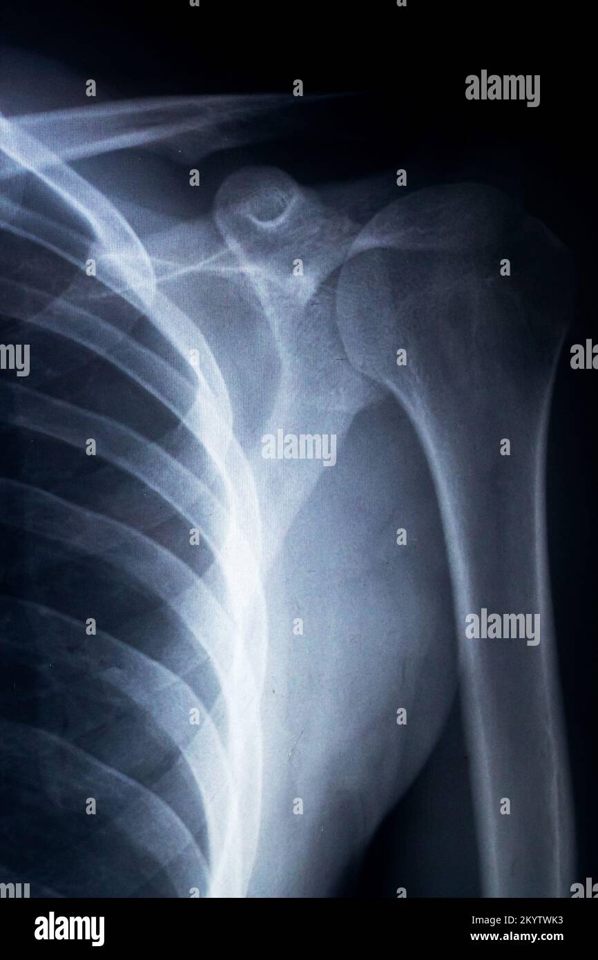 Shoulder x ray image hi-res stock photography and images - Alamy